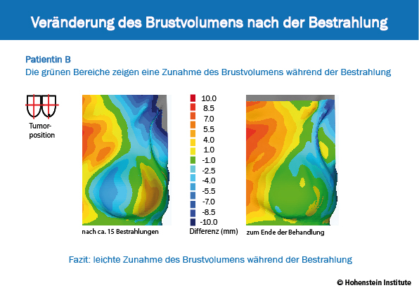 Researchers develop bra for breast cancer patients